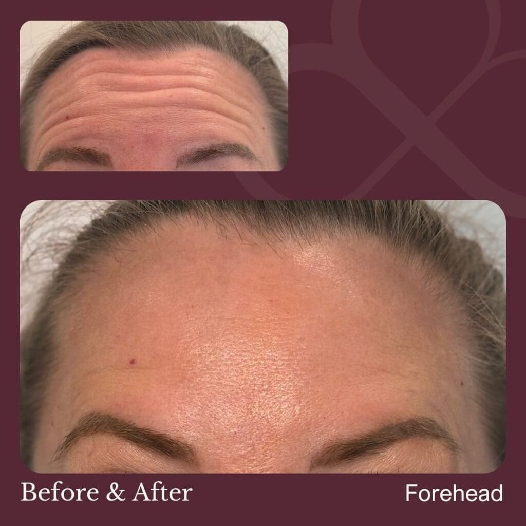 A Comprehensive Guide to Common Botox Treatment Areas - Revery Medical ...